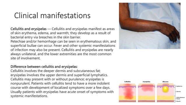 Cellulitis, erysipelas, abscess presentation | PPTX | Infectious ...