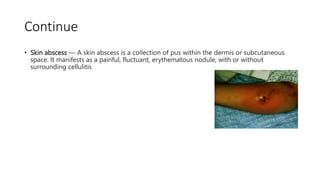Cellulitis, erysipelas, abscess presentation | PPTX