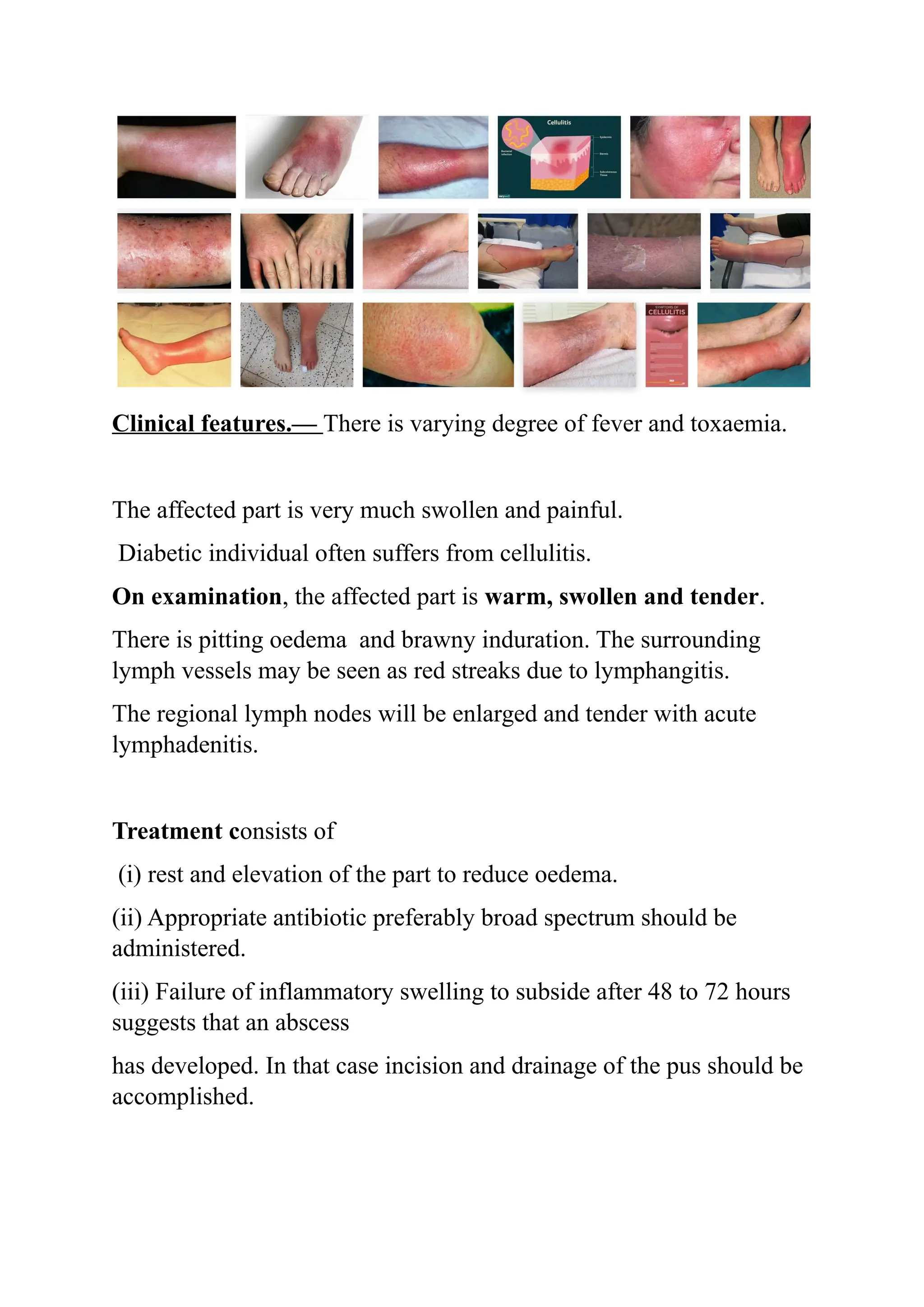 cellulitis , ulcers -general surgery.docx