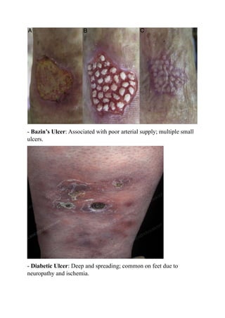 cellulitis , ulcers -general surgery.docx
