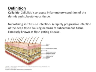 Cellulitis vs necrotizing soft tissue infection | PPTX