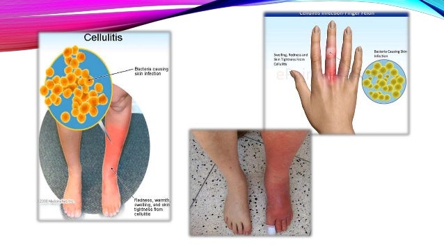 Celulitis