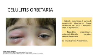 celulitis preseptal y postseptal en pediatria | PPTX
