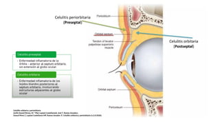 celulitis preseptal y postseptal en pediatria | PPTX