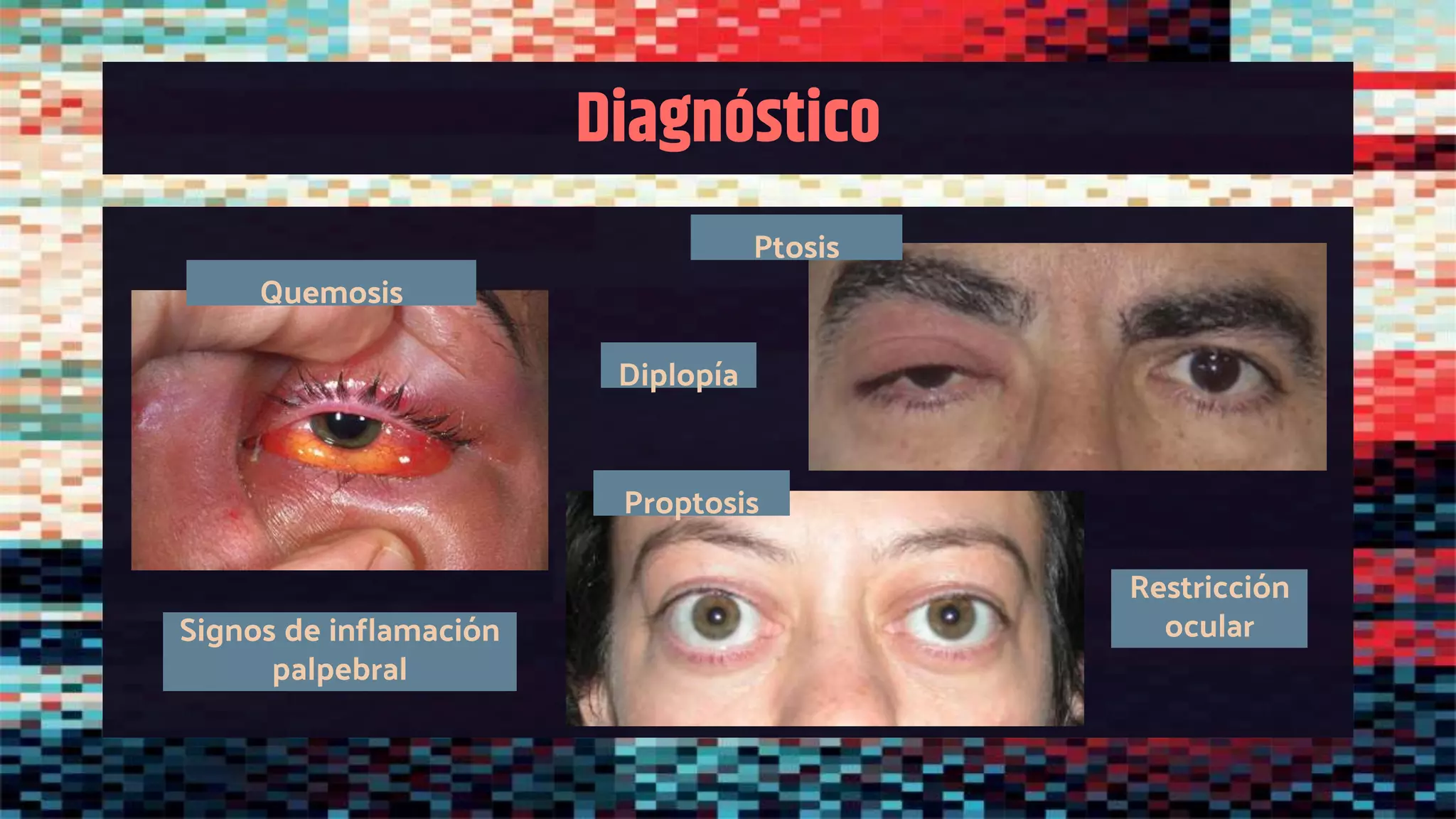 Celulitis orbitaria anterior y posterior