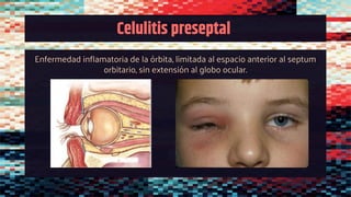 Celulitis orbitaria anterior y posterior | PPTX