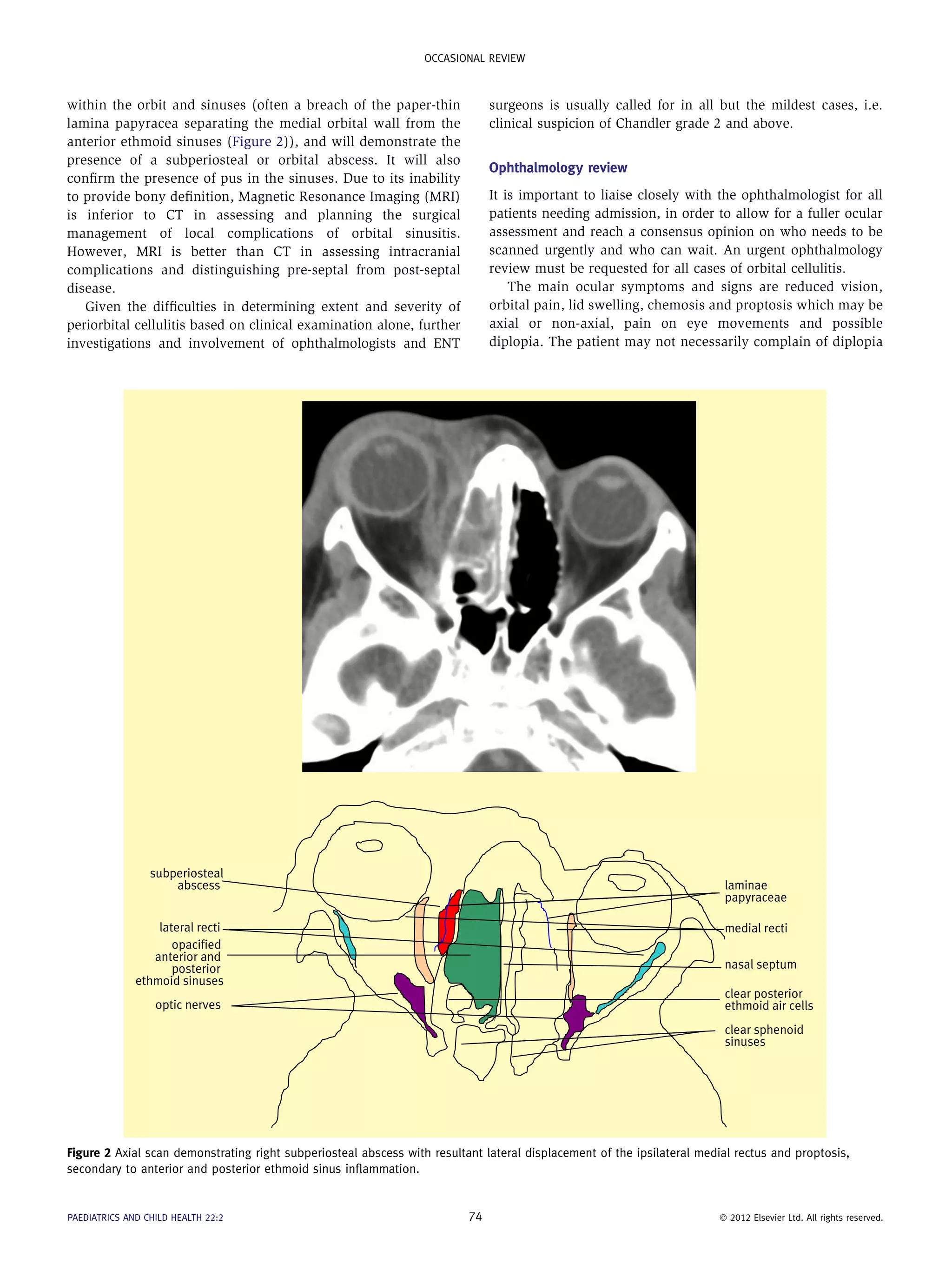 Celulitis periorbitaria | PDF