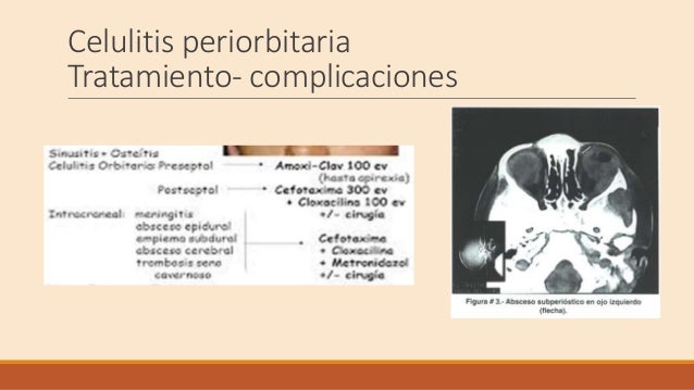 Celulitis periorbitaria