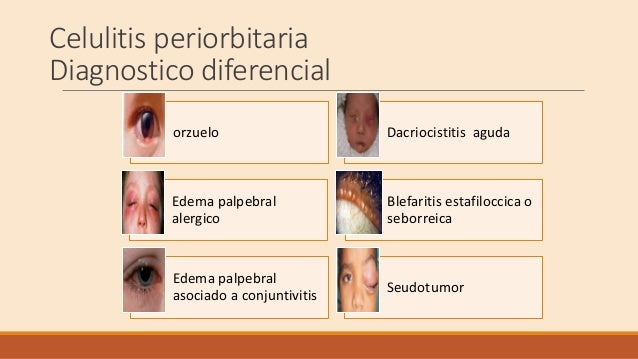 Celulitis periorbitaria