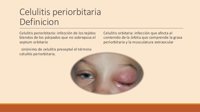 Celulitis periorbitaria