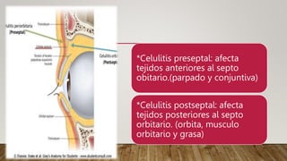 celulitis periorbitaria.pptx