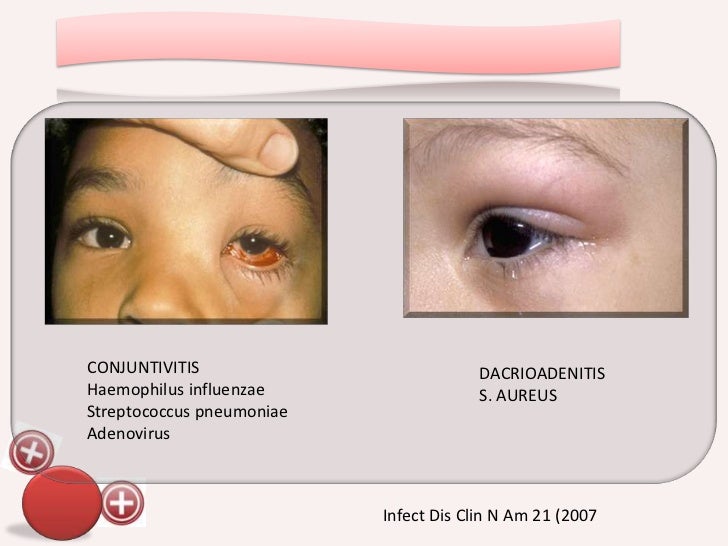 Celulitis periorbitaria 1