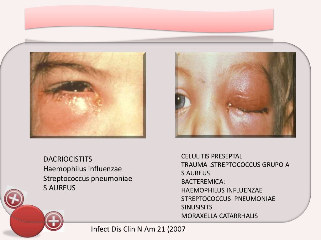 Celulitis periorbitaria 1