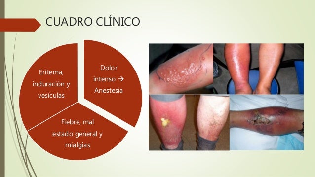 Celulitis y Fascitis Necrotizante
