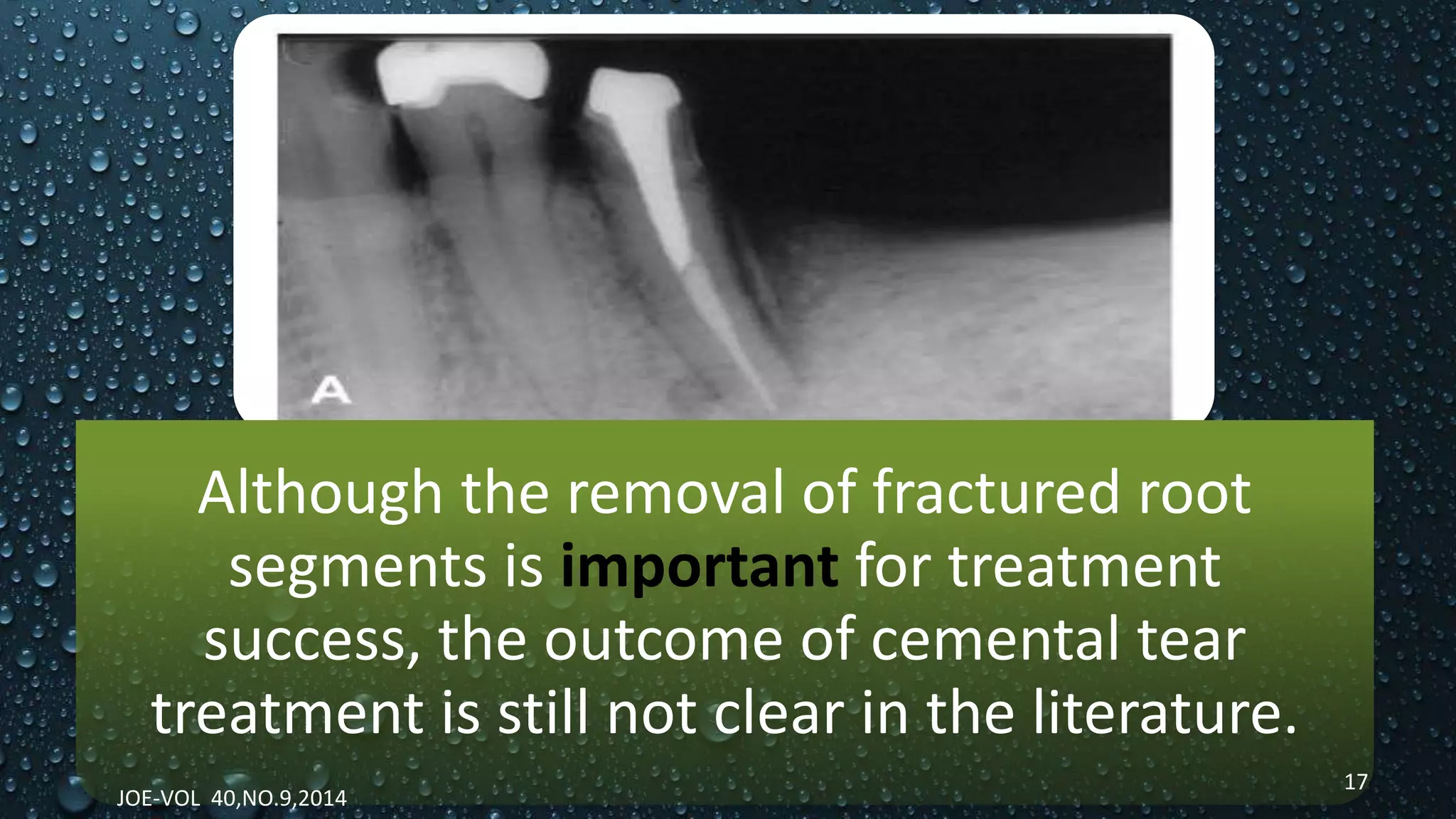 Treatment outcome of the Teeth with Cemental Tears -DR.ANUBHUTI | PPTX