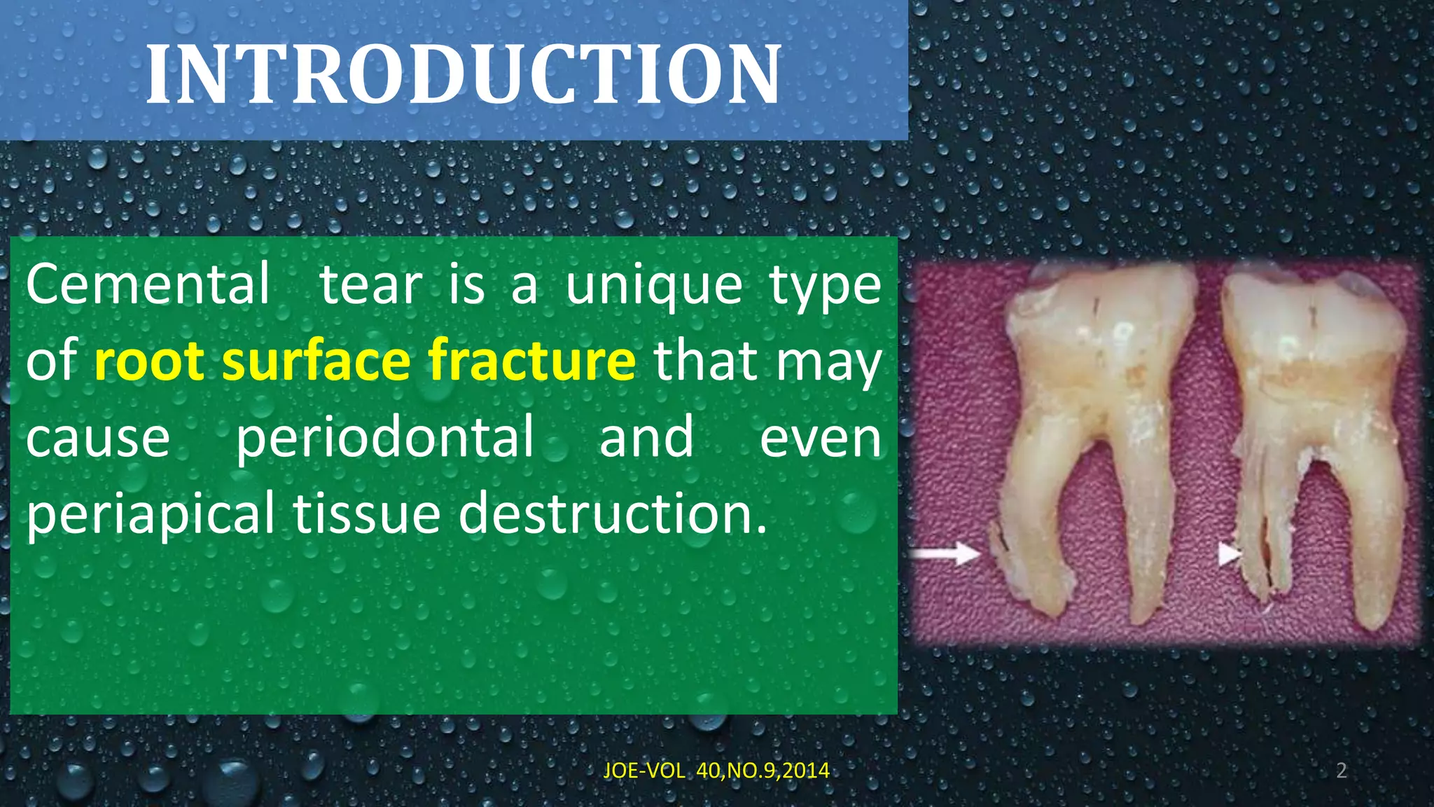 Treatment outcome of the Teeth with Cemental Tears -DR.ANUBHUTI | PPTX