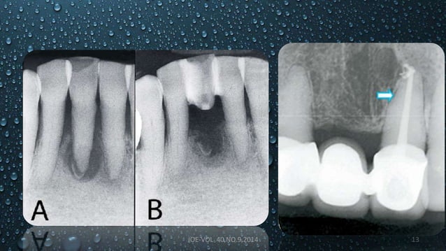 Treatment outcome of the Teeth with Cemental Tears -DR.ANUBHUTI | PPTX ...