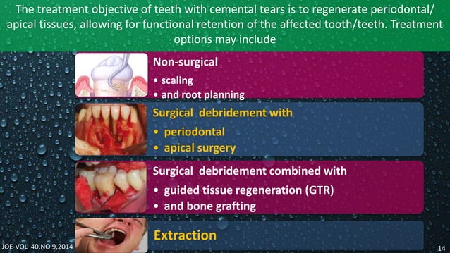 Treatment outcome of the Teeth with Cemental Tears -DR.ANUBHUTI | PPTX ...