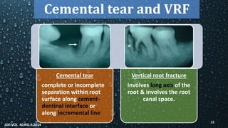 Treatment outcome of the Teeth with Cemental Tears -DR.ANUBHUTI | PPTX ...