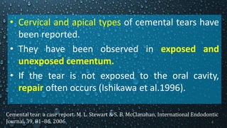 Treatment outcome of the Teeth with Cemental Tears -DR.ANUBHUTI | PPTX