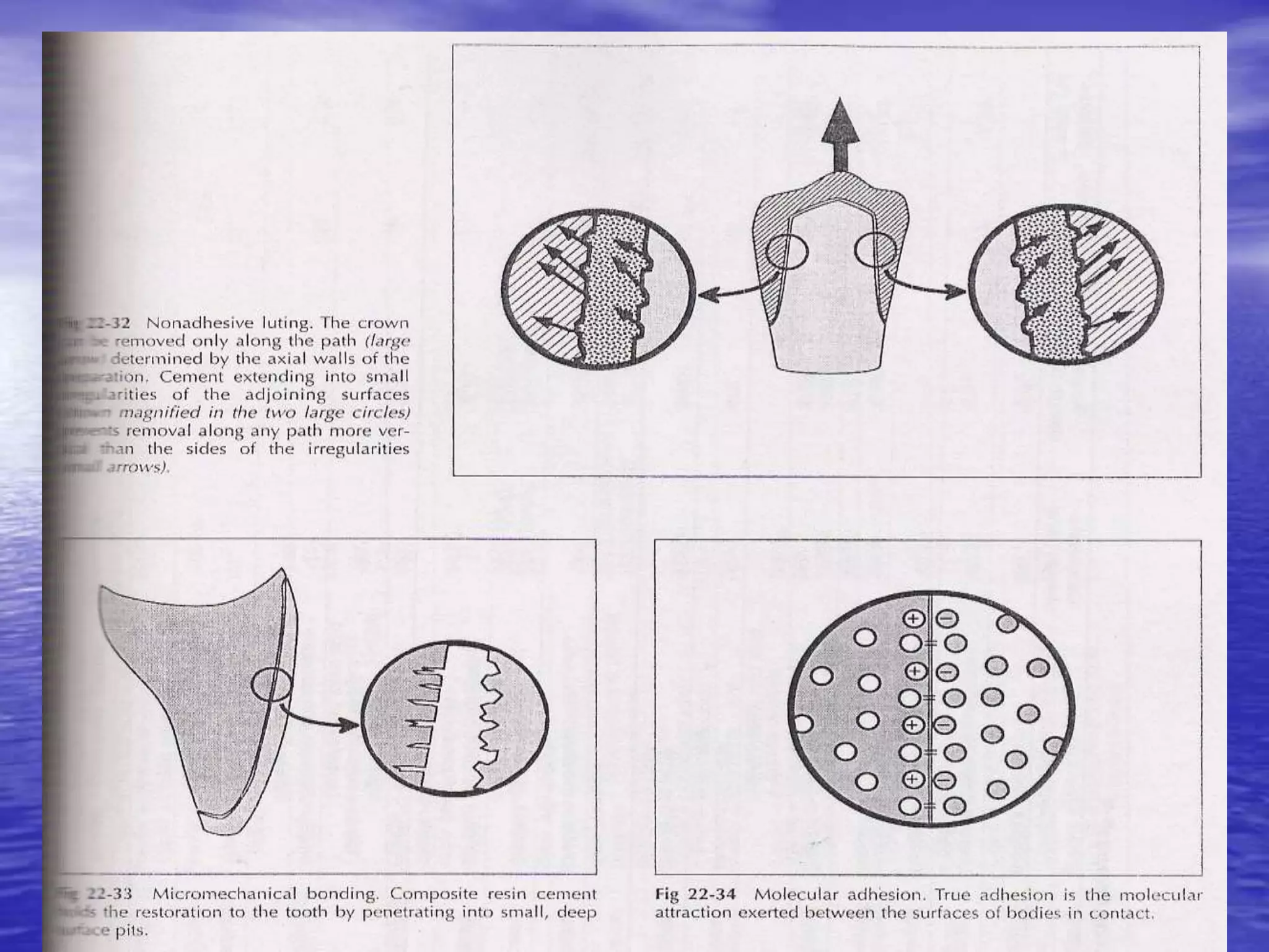 Cementation procedures in fpd | PPT