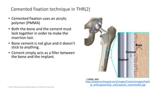 Cemented versus uncemented fixation in total hip replacement | PPTX