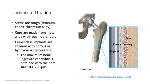 Cemented versus uncemented fixation in total hip replacement | PPTX ...