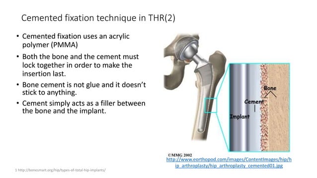 Cemented versus uncemented fixation in total hip replacement