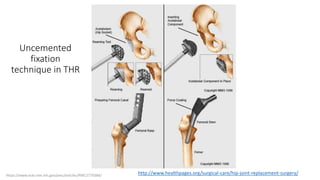 Cemented versus uncemented fixation in total hip replacement | PPT