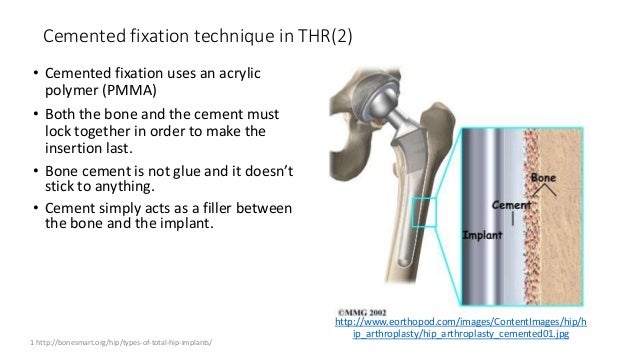 Cemented versus uncemented fixation in total hip replacement