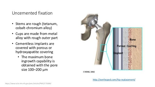 Cemented versus uncemented fixation in total hip replacement