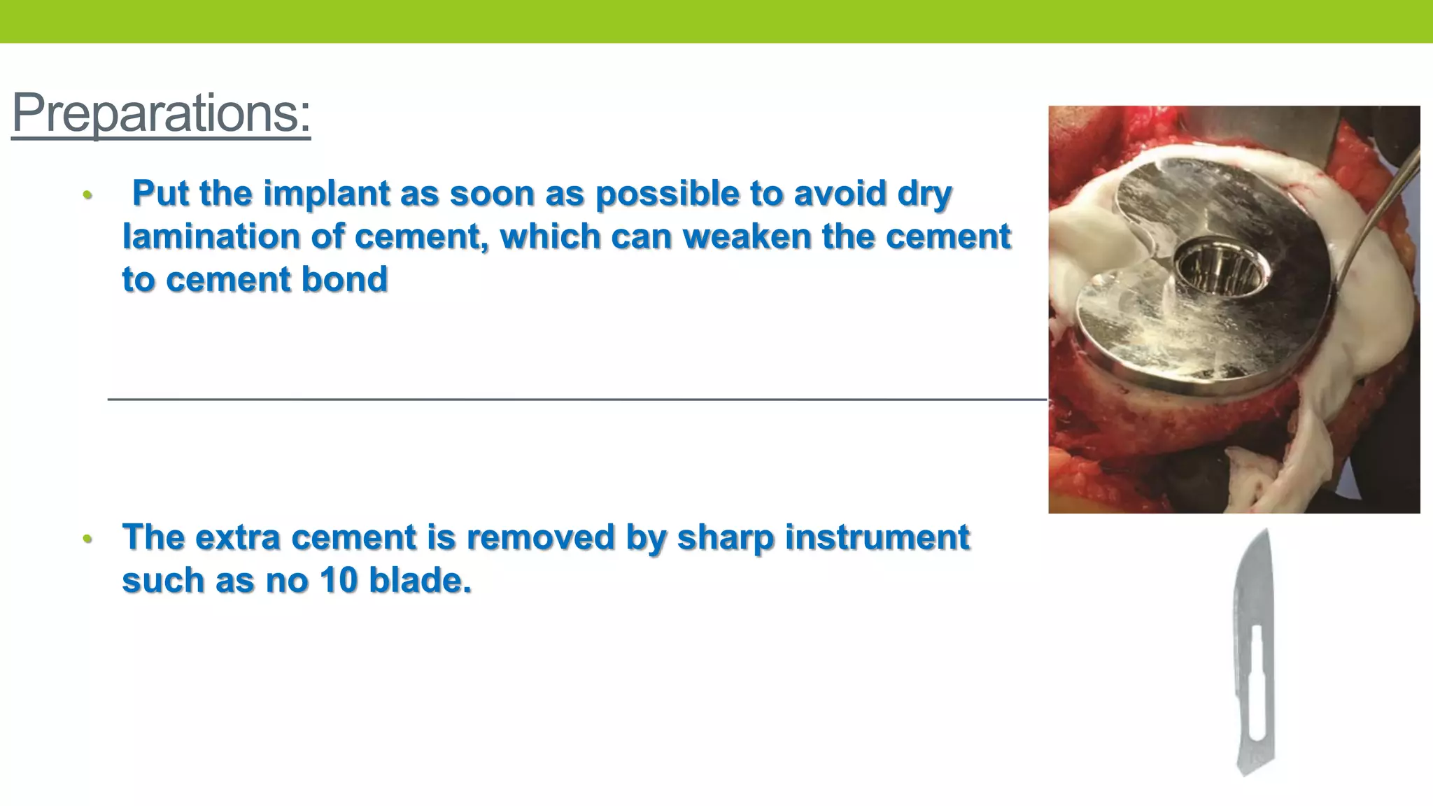 CEMENTING IN TOTAL KNEE REPLACEMENT SURGERY | PPTX