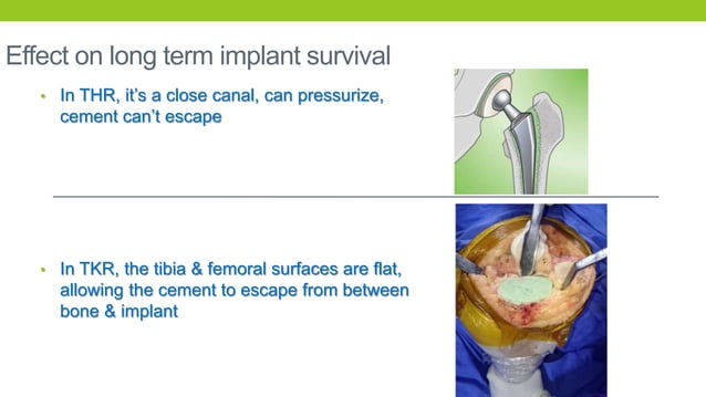 CEMENTING IN TOTAL KNEE REPLACEMENT SURGERY | PPTX