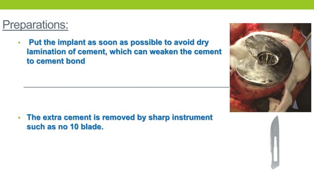 CEMENTING IN TOTAL KNEE REPLACEMENT SURGERY | PPTX