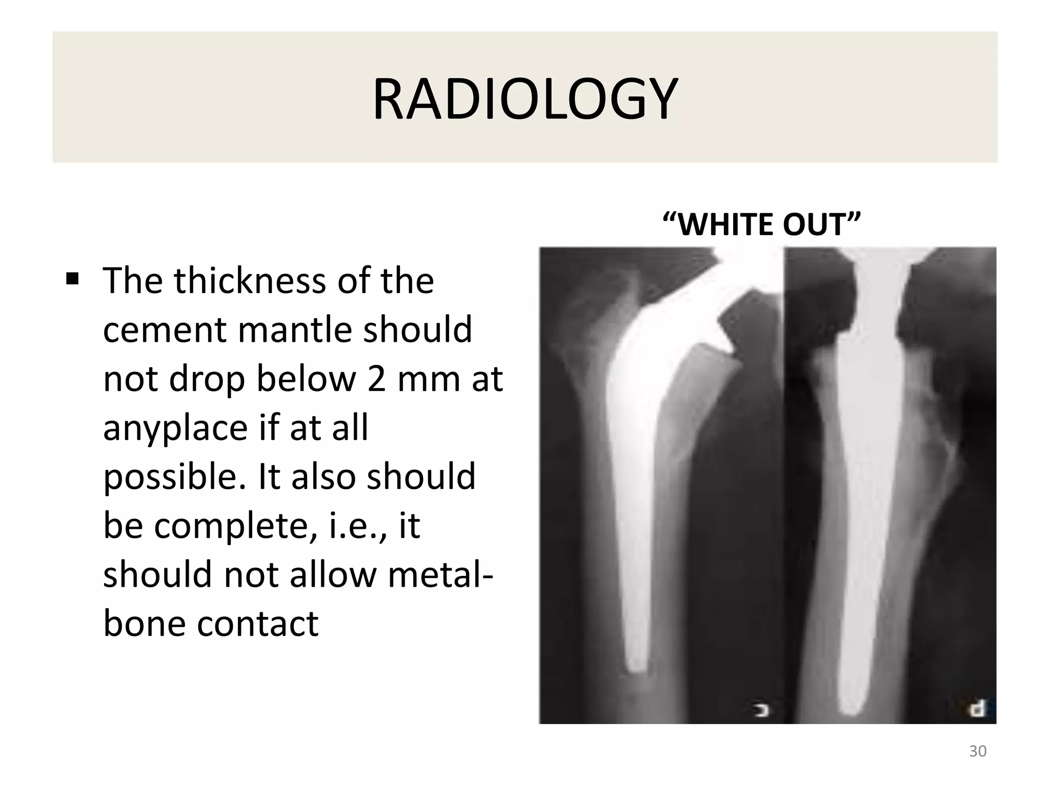 Bone cement,Cementing Generations, Complications & Recent advances | PPTX