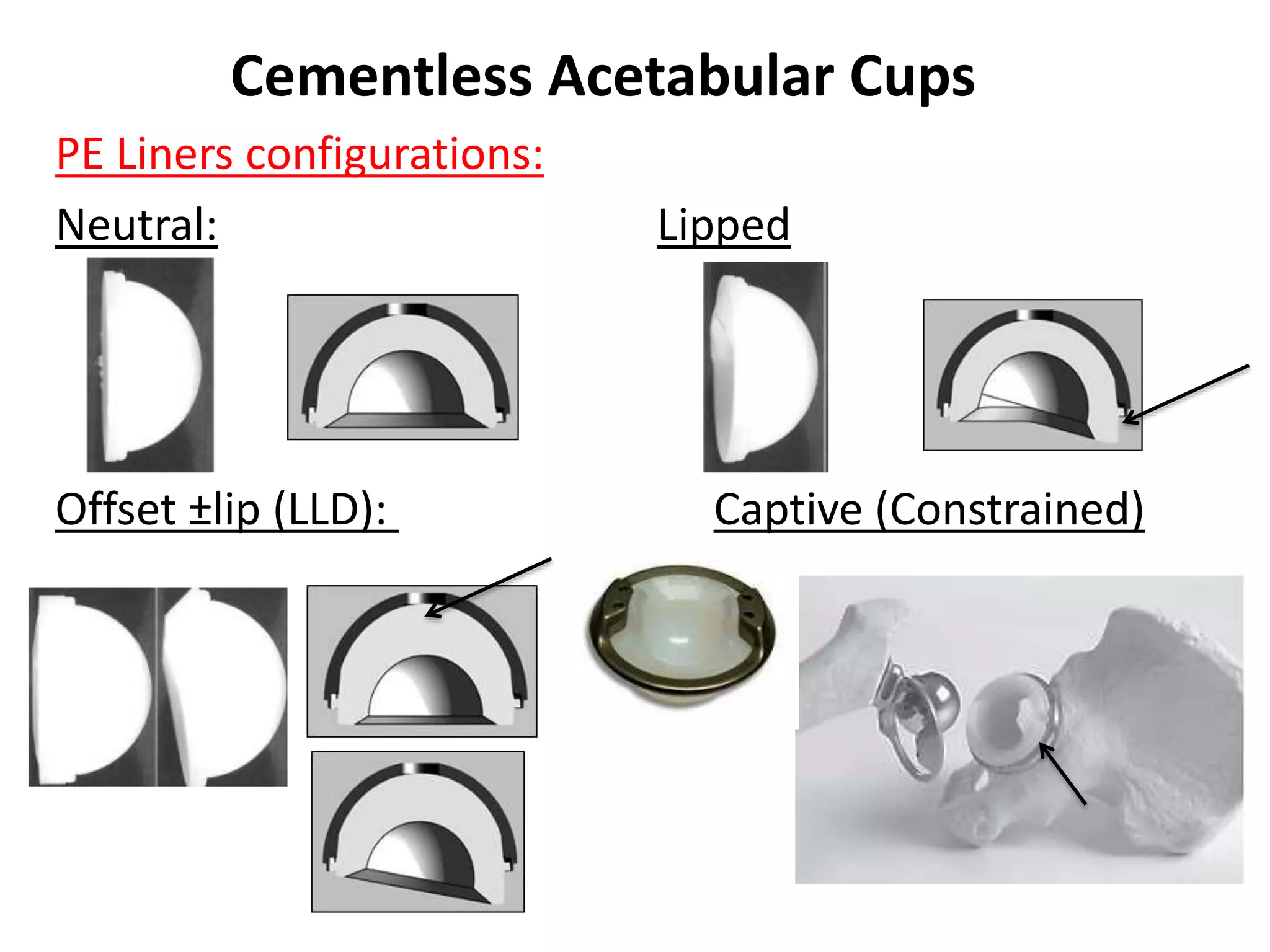 Cementless acetabular cups | PPTX