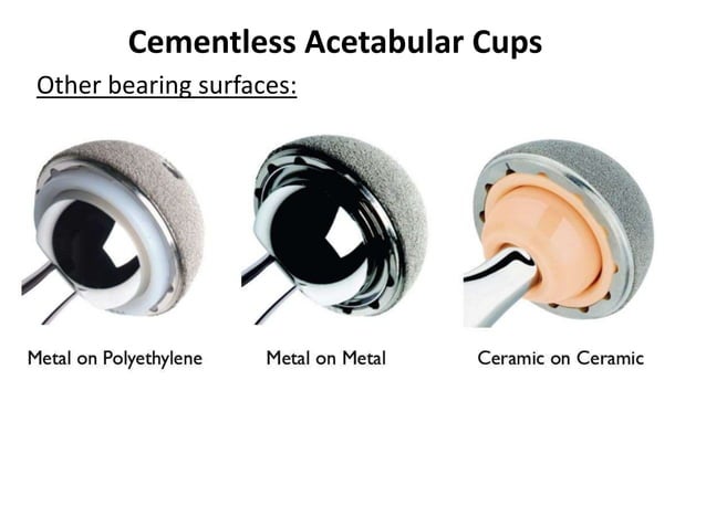 Cementless acetabular cups | PPTX | Bone and Joint Conditions ...