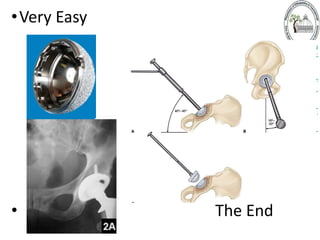Cementless acetabular cups | PPTX