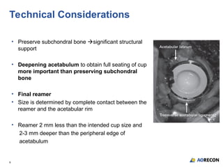 Cementless cup final (AO Recon Athens 2017).ppt