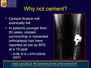 Cementless TKA | PPT