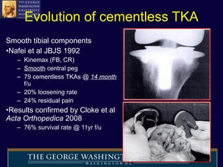Cementless TKA | PPT