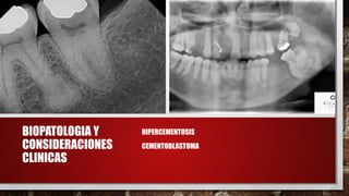 cemento radicular y partes del periodonto | PPTX