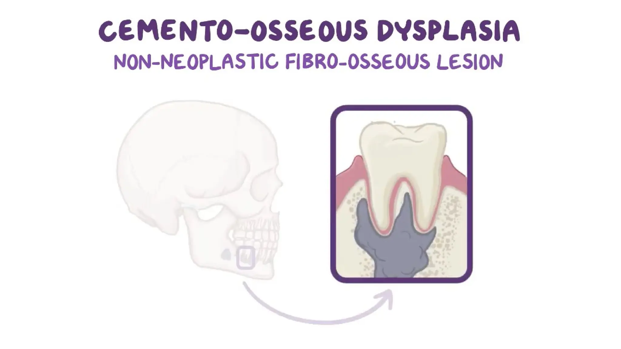 CEMENTO-OSSEOUS DYSPLASIAS power point for students | PPTX