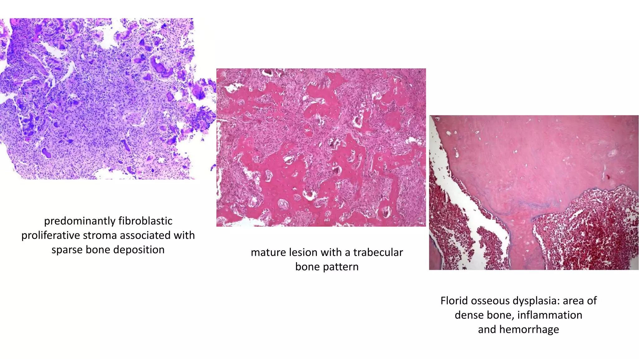 Cemento osseus dysplasia (Doctor Faris Alabeedi MSc, MMedSc, PgDip, BDS ...