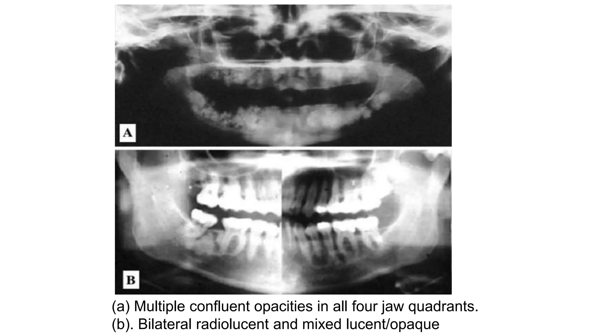 Cemento osseus dysplasia (Doctor Faris Alabeedi MSc, MMedSc, PgDip, BDS ...