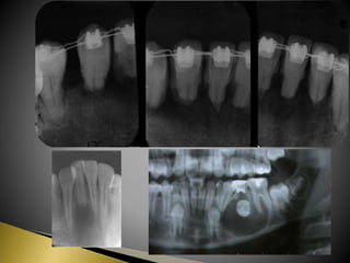 Cemento radicular | PPTX