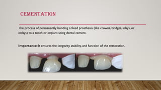 cement selection in fixed prosthodontics | PPT