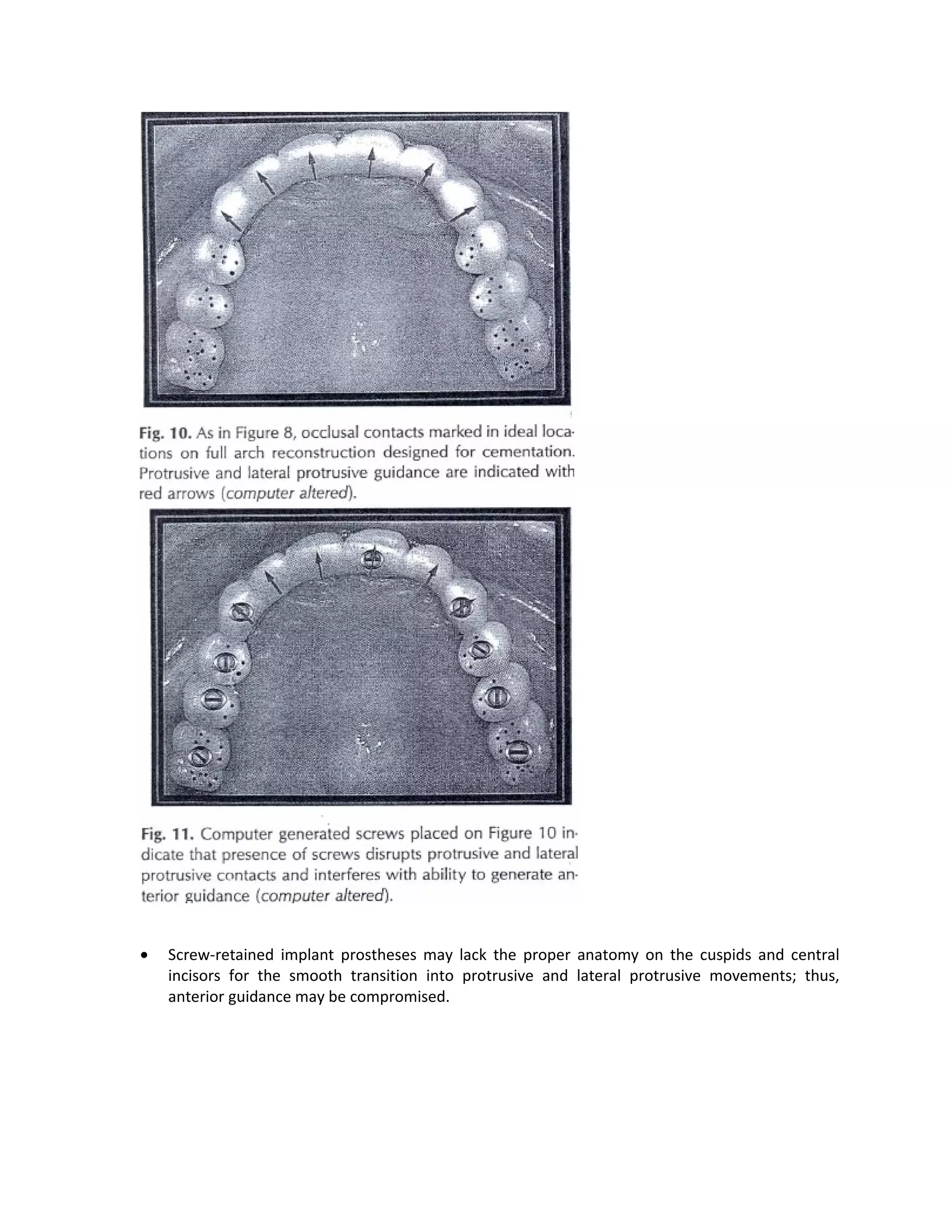 Cement Retained Versus Screw Retained Implant Restorations Achieving ...