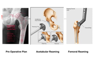Cementing Technique in Arthroplasty - tips, tricks and Traps | PPT