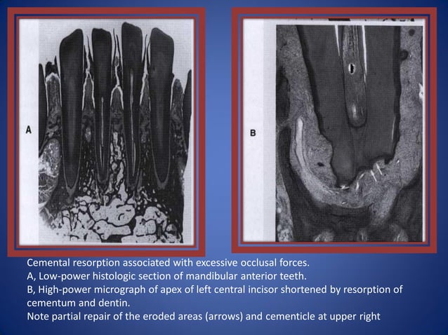 Cementum | PDF | Dental Health | Diseases and Conditions